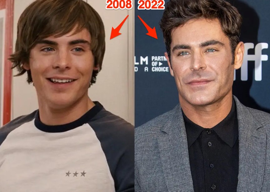 Zac Efron Before and After, What Happened to Zac Efron Jaw Surgery?